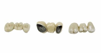 Fixed Bridges, Dental Bridge Leesburg VA | Riverside Dental